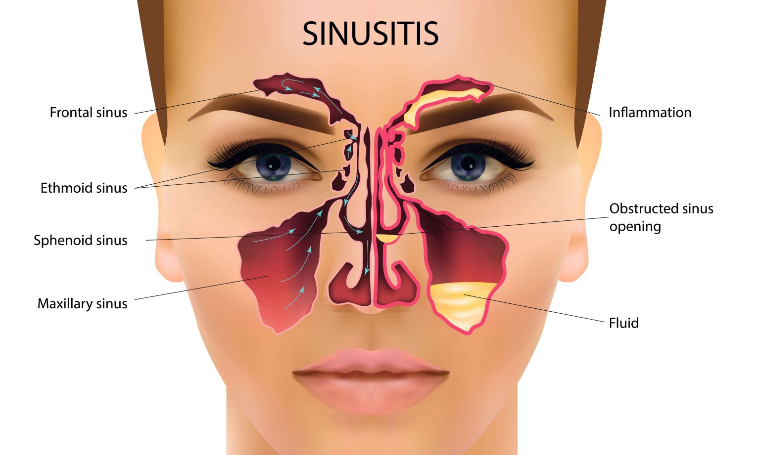 Sinusitis - Ambient Virtual Care